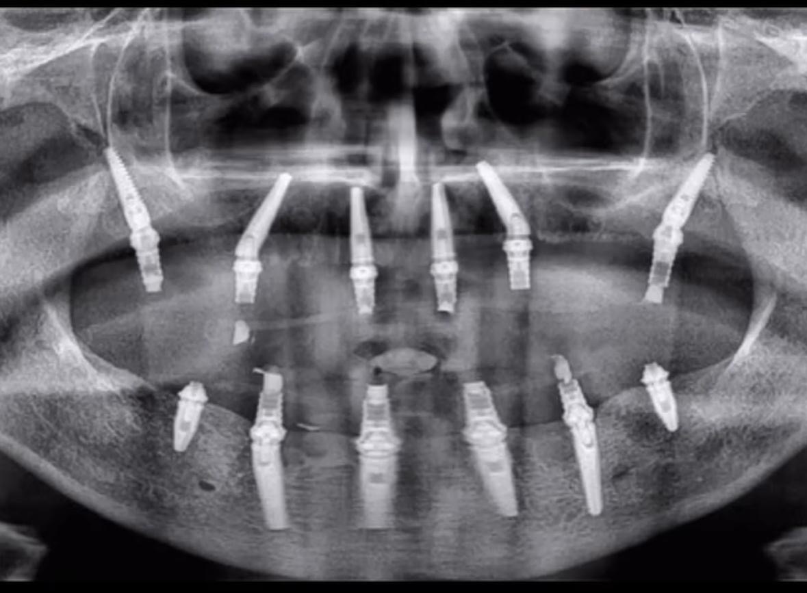 Global Implant Institute - Advanced Dental Implantology Courses